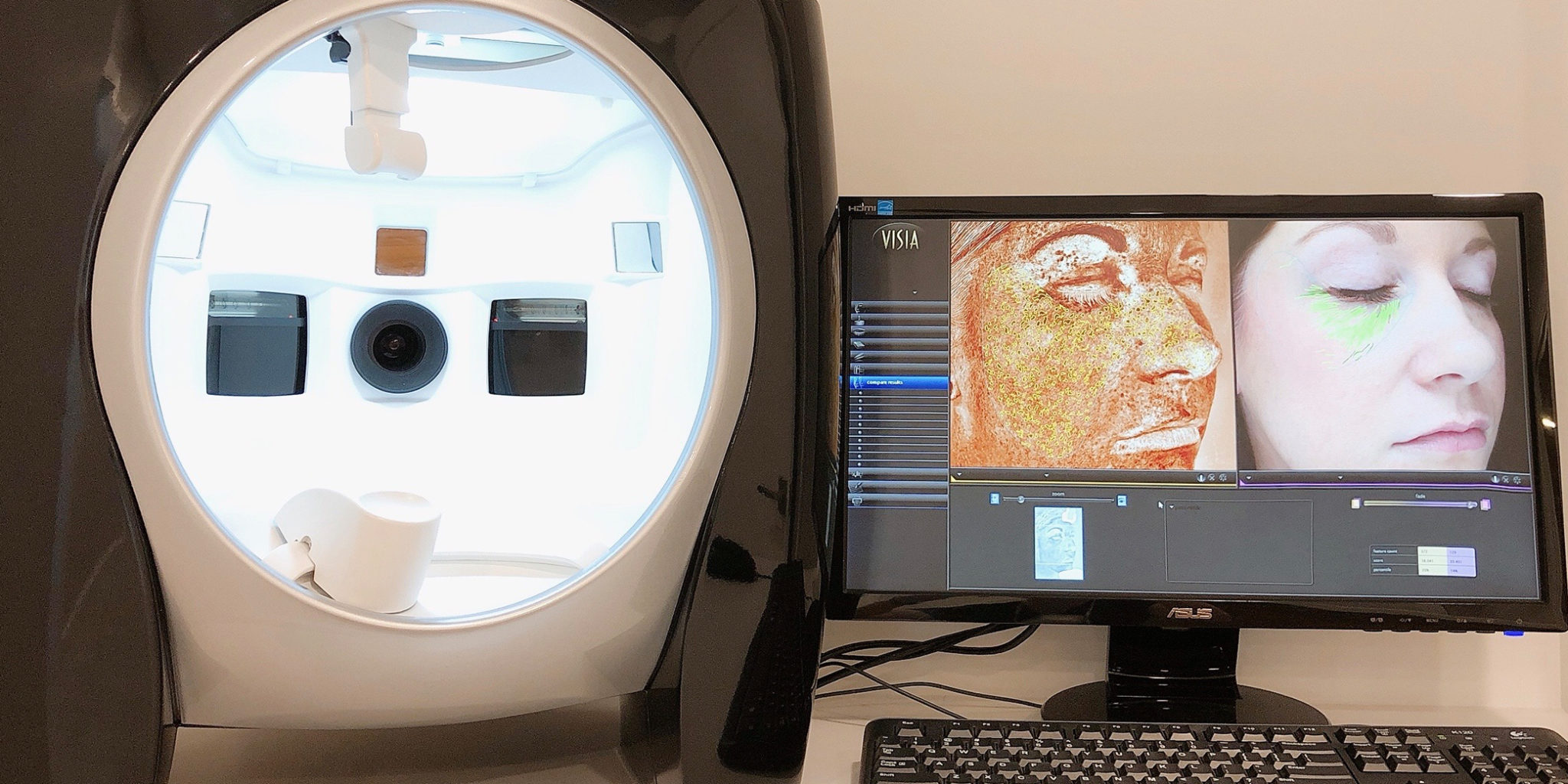 VISIA® Complexion Analysis - Peraza Dermatology Group