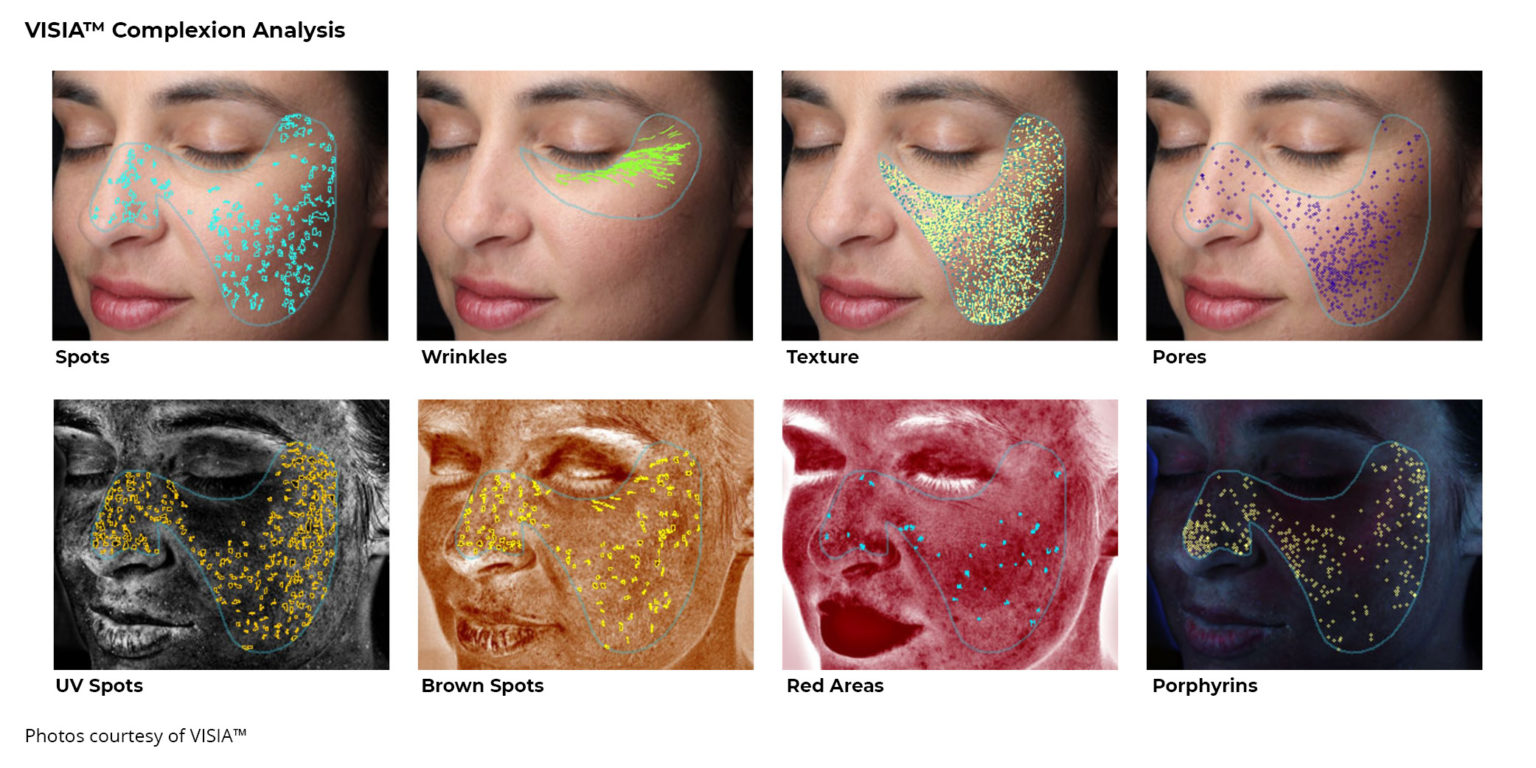 VISIA® Complexion Analysis - Peraza Dermatology Group